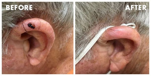 Mohs Surgery Alternative | Image Guided SRT in Cleveland