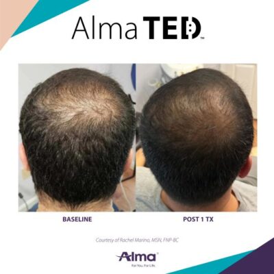 Alma TED Hair Loss Treatment | Non-Invasive | Cleveland, OH
