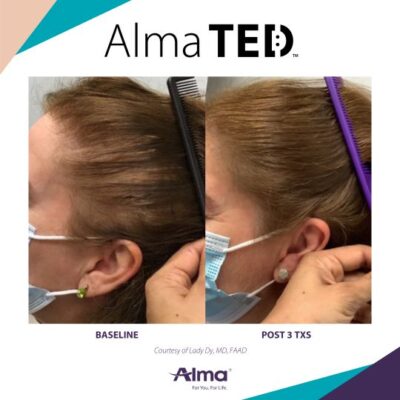 Alma TED Hair Loss Treatment | Non-Invasive | Cleveland, OH