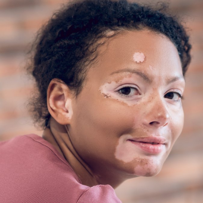 Vitiligo & Psoriasis Treatment in Cleveland | White Patchy Skin | XTRAC